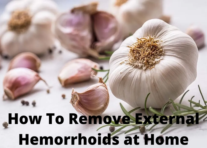 How To Remove External Hemorrhoids At Home Techvtimes